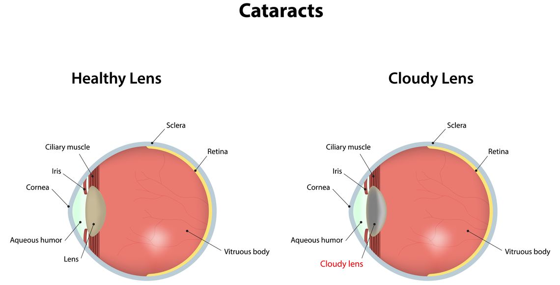 Color Blindness Cataracts